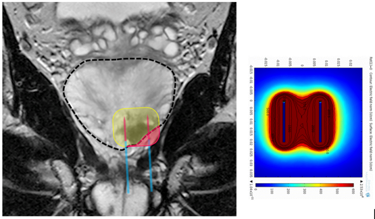 IRE process in detail