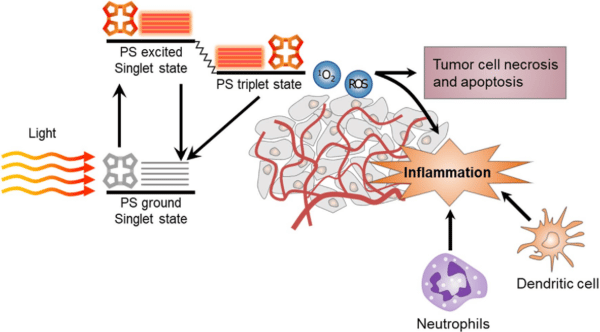 Photodynamic Therapy for the Treatment of Bladder Cancer - VITUS ...