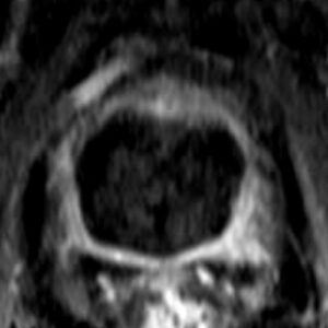 IRE - NanoKnife™ in prostate cancer