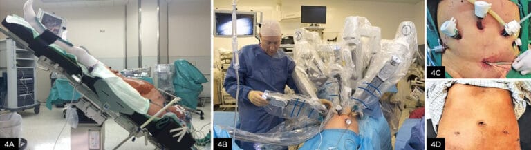 Davinci Robotic Prostatectomy Vitus Private Clinic