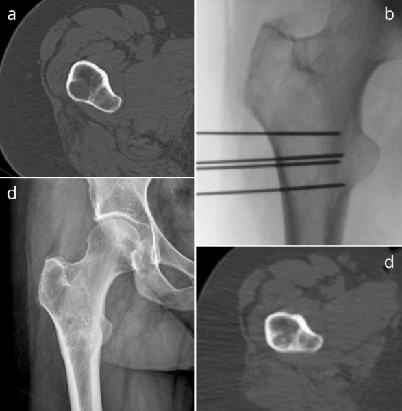 IRE/ECT for lymph node and bone metastases
